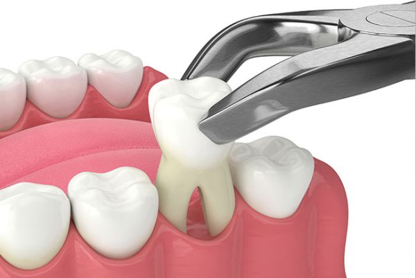 Tooth Extraction – Sea Breeze Dental Group